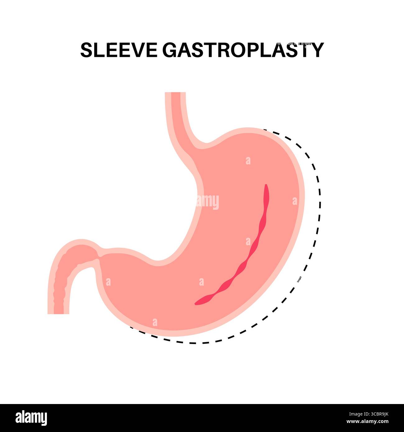 Illustration of an endoscopic sleeve gastroplasty (ESG). This is a ...
