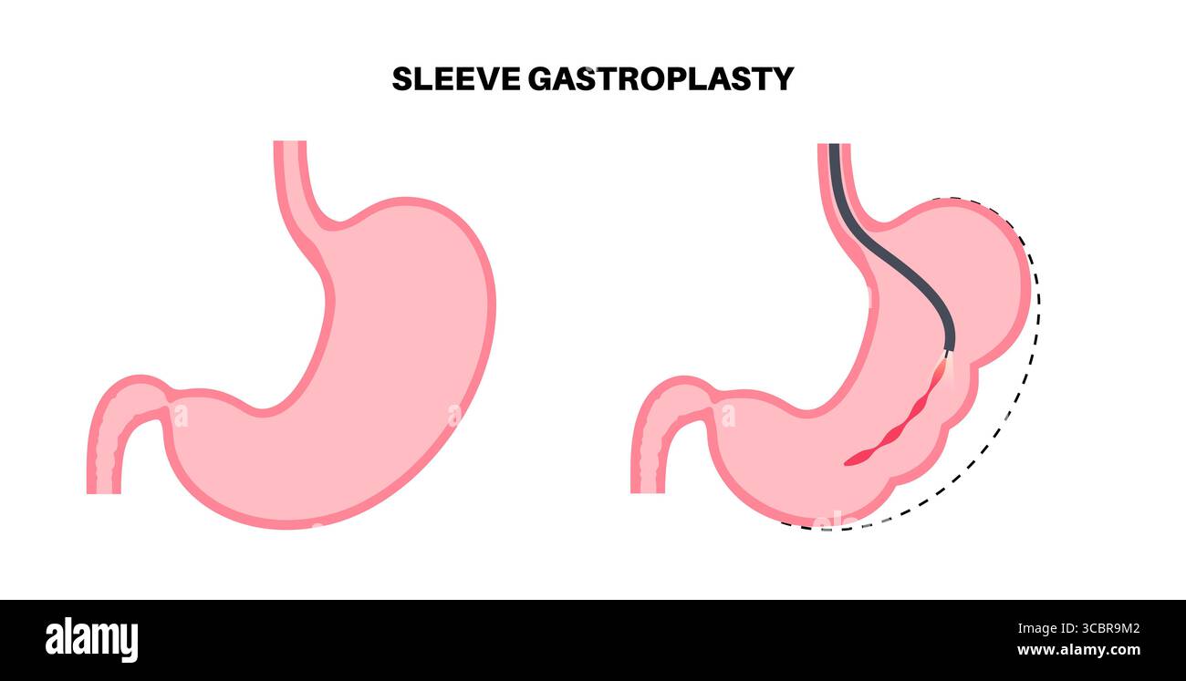 Illustration of an endoscopic sleeve gastroplasty (ESG). This is a ...