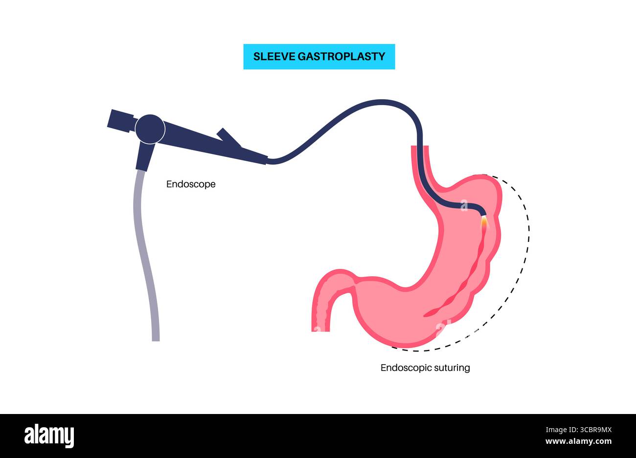 Surgical sleeve gastrectomy hi-res stock photography and images - Alamy