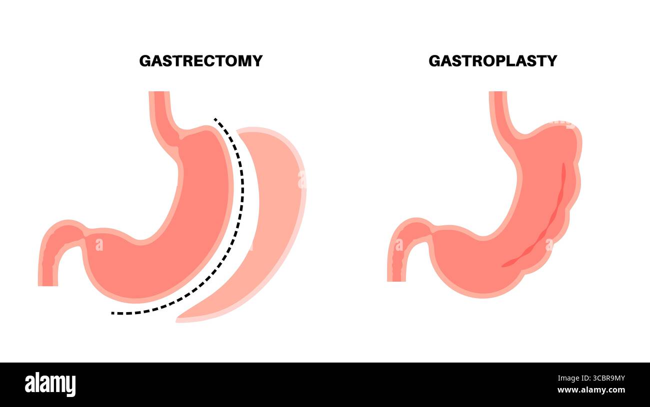 Illustration of a surgical sleeve gastrectomy and an endoscopic sleeve ...