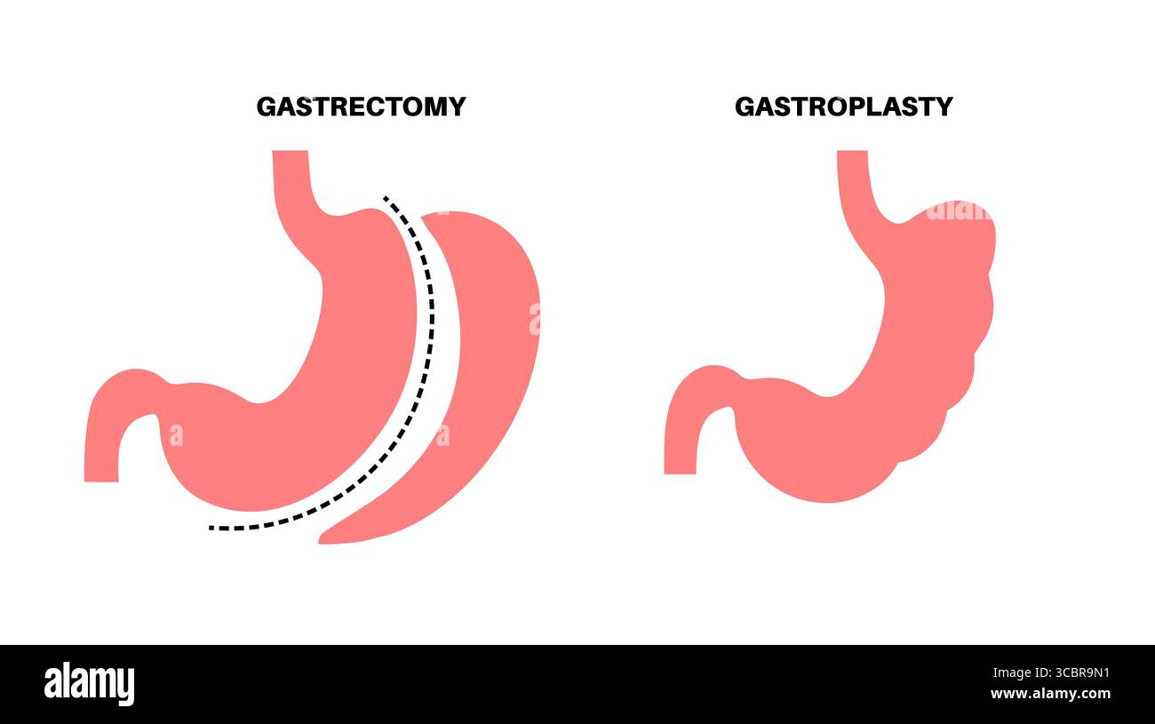 Illustration of a surgical sleeve gastrectomy and an endoscopic sleeve ...