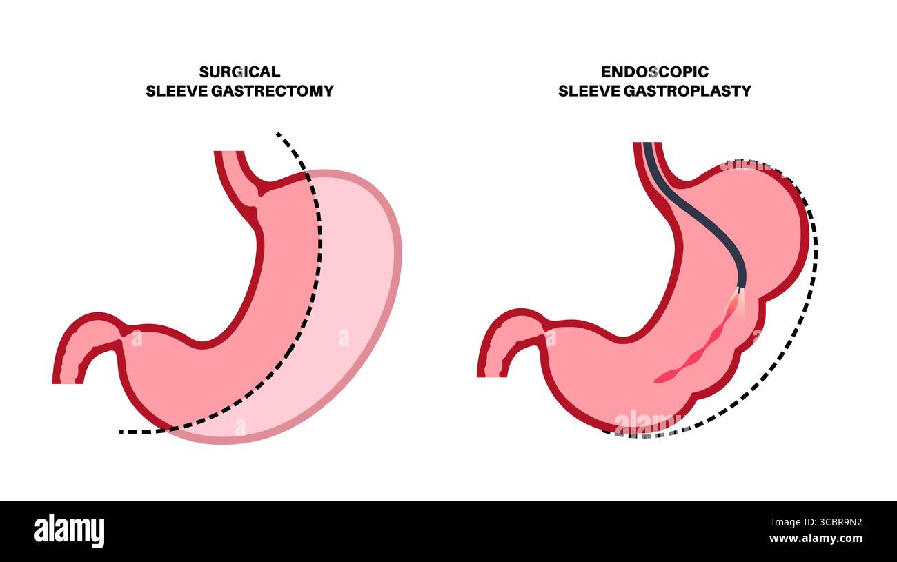 Illustration of a surgical sleeve gastrectomy and an endoscopic sleeve ...