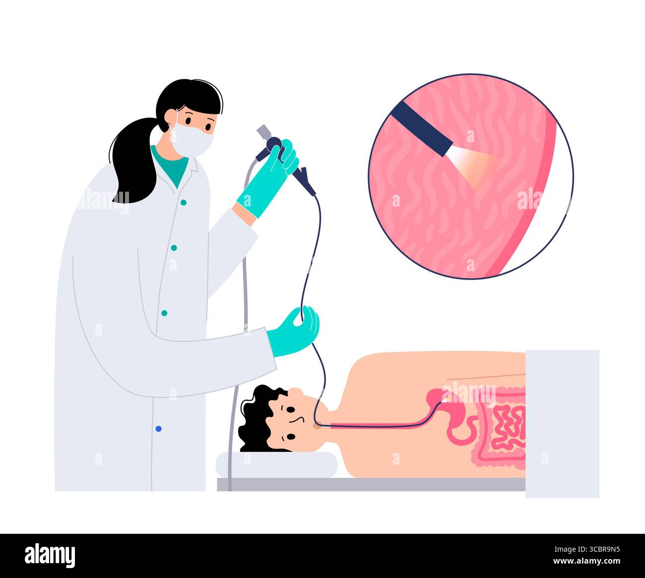 Illustration of a gastroscopy, also known as an upper endoscopy. This ...