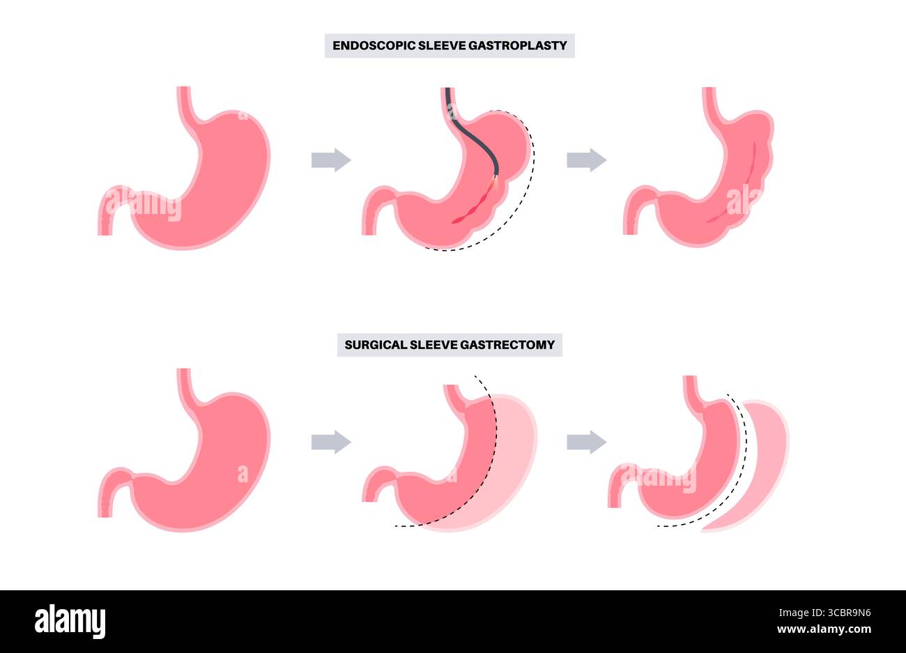 Illustration of a surgical sleeve gastrectomy and an endoscopic sleeve ...