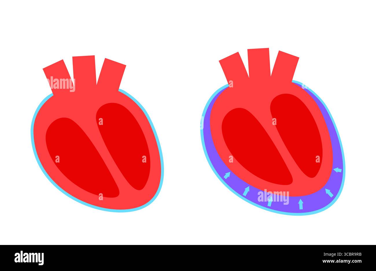 Illustration of pericardial effusion the heart. This is the buildup of ...