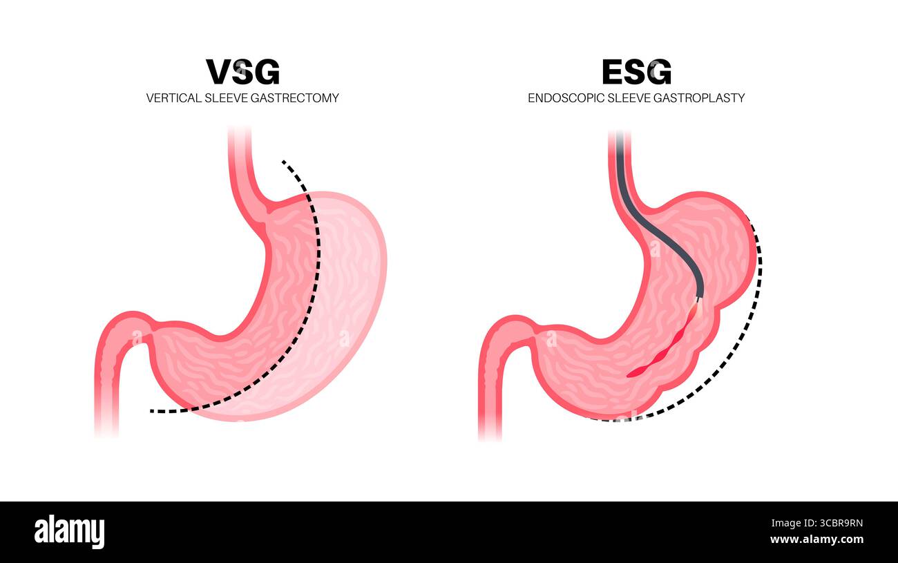 Illustration of a surgical sleeve gastrectomy and an endoscopic sleeve ...
