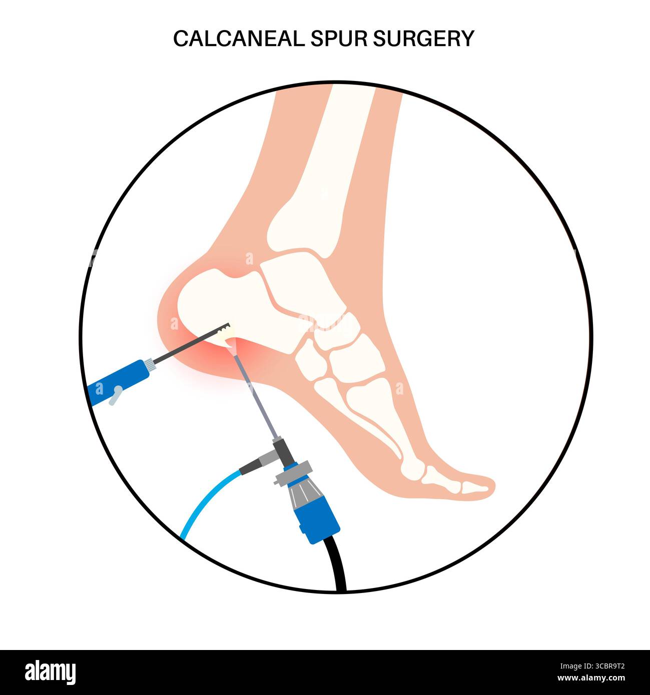 Bone defect Cut Out Stock Images & Pictures - Alamy