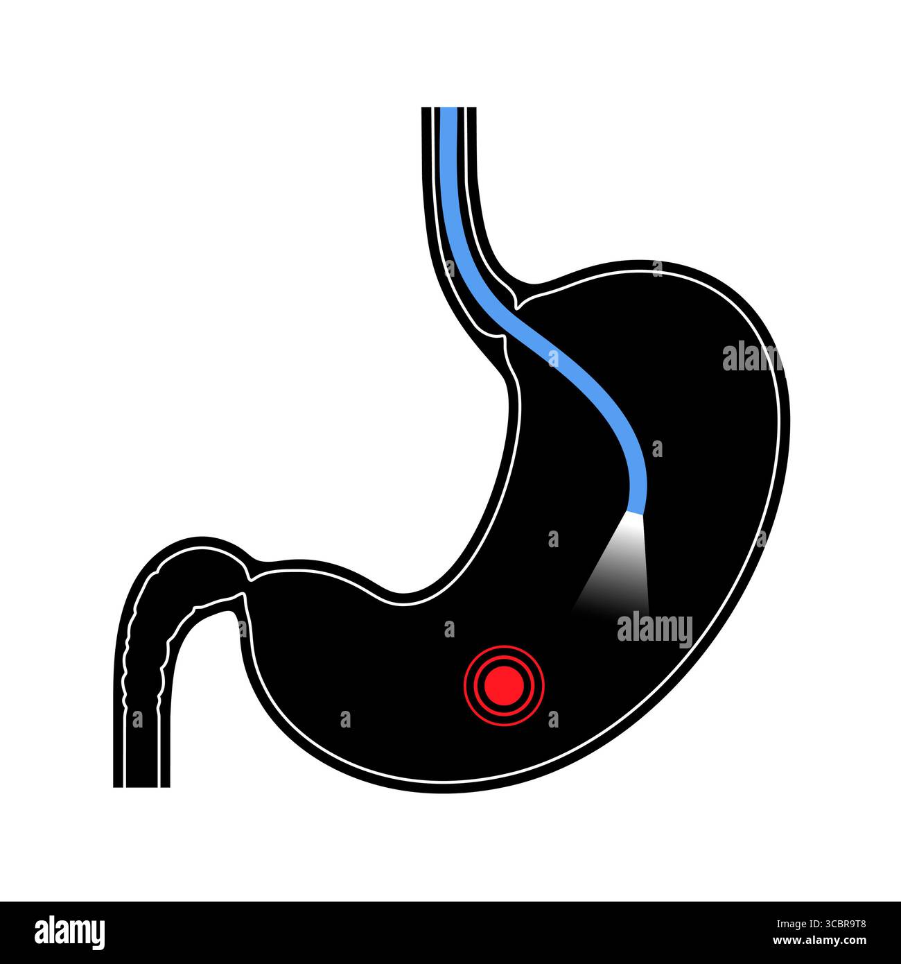 Ulcers endoscopy hi-res stock photography and images - Alamy