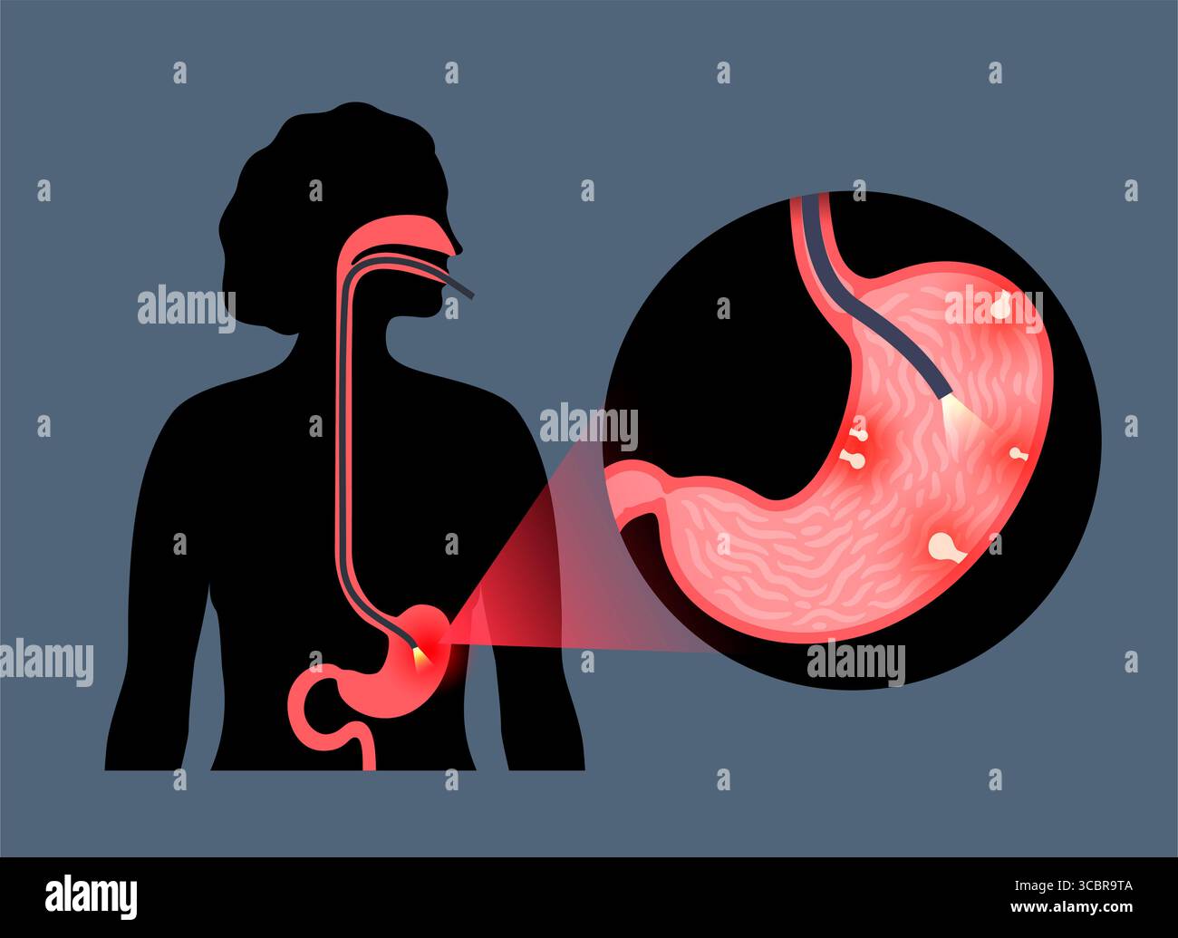 Illustration of a gastroscopy, also known as an upper endoscopy. This ...