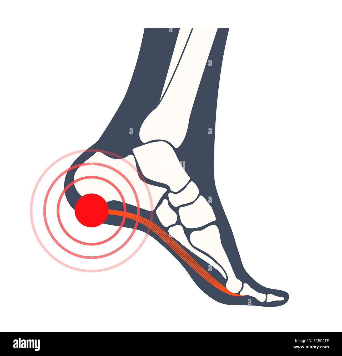 Illustration of heel pain. This is commonly caused by plantar fasciitis ...