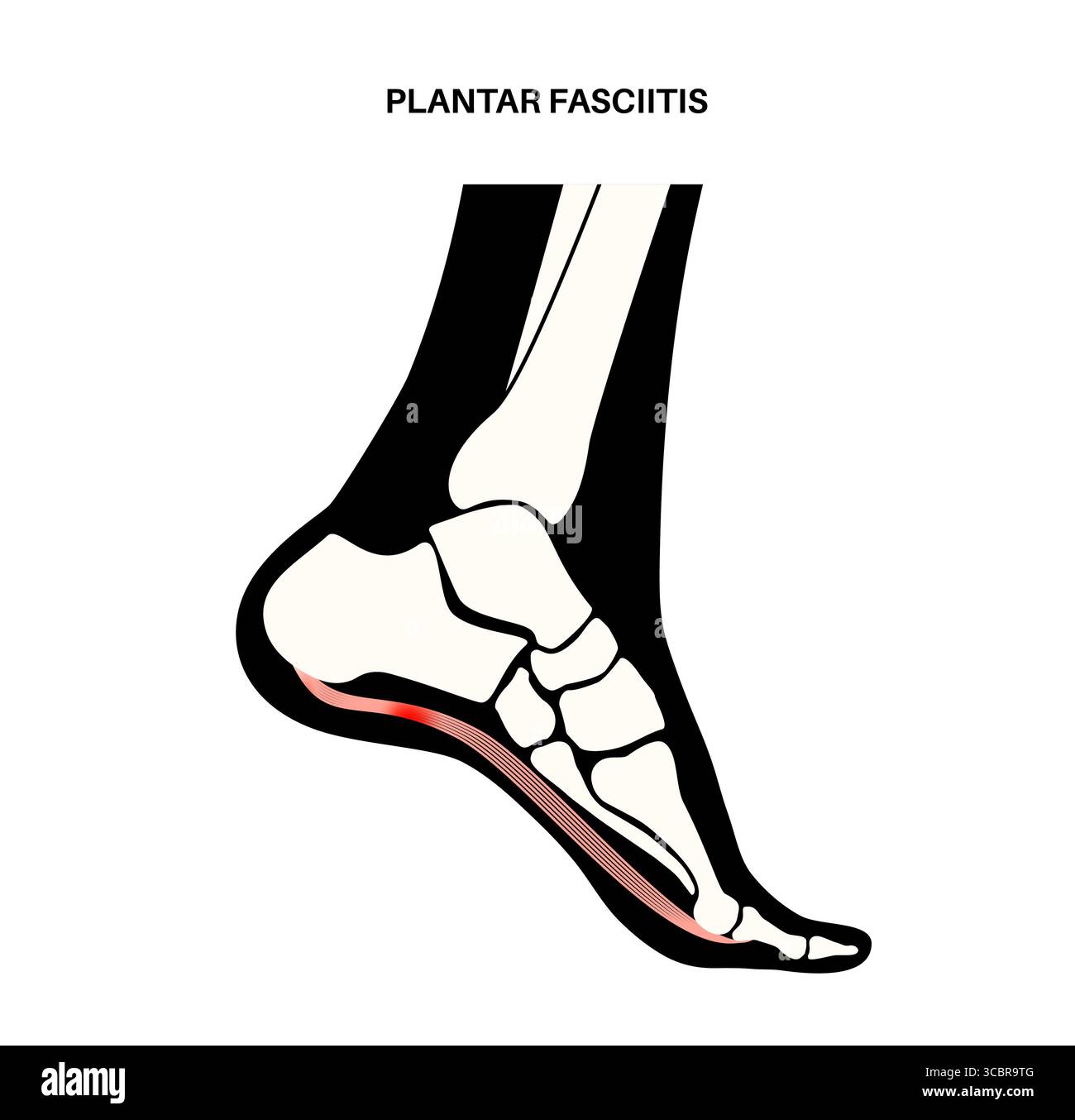 Anatomy of plantar fascia hi-res stock photography and images - Alamy