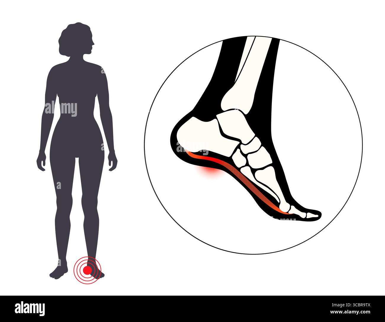 Illustration of heel pain. This is commonly caused by plantar fasciitis ...