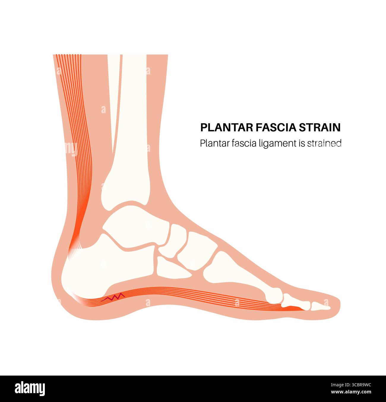 Anatomy of plantar fascia hi-res stock photography and images - Alamy