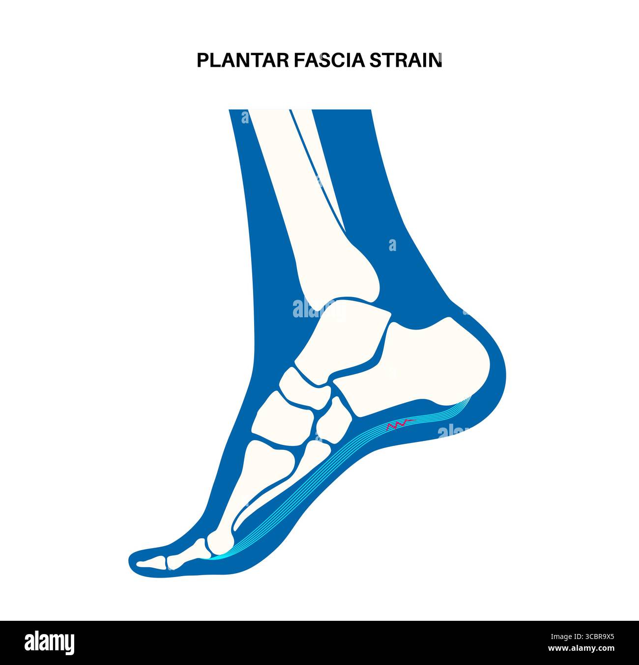 Illustration of plantar fasciitis. This is inflammation of the plantar ...