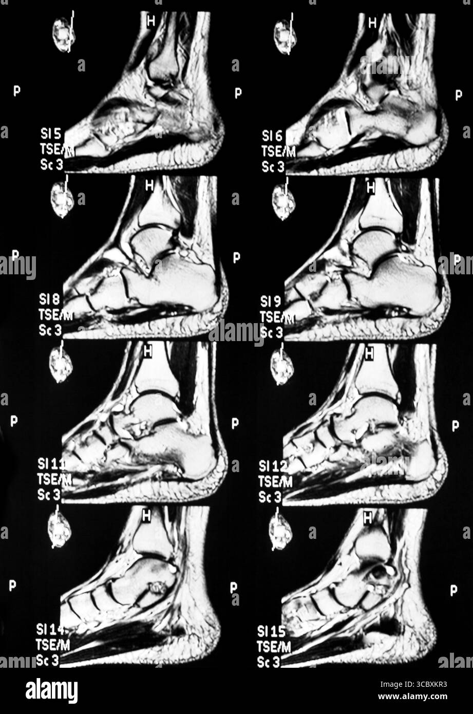 Ct scan ankle foot Black and White Stock Photos & Images - Alamy