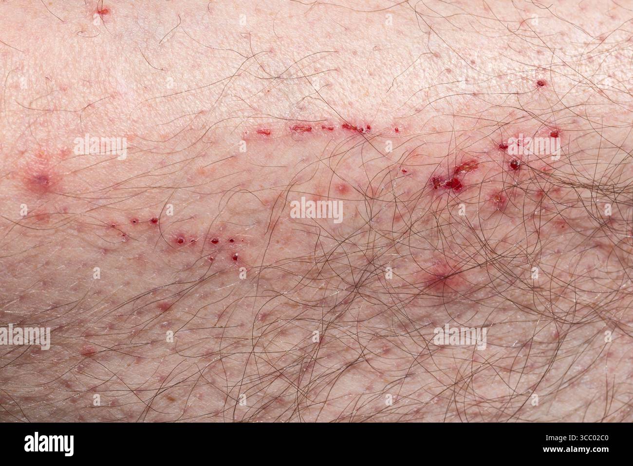 Close up leg skin with red spots after being bitten by mosquitos or ...