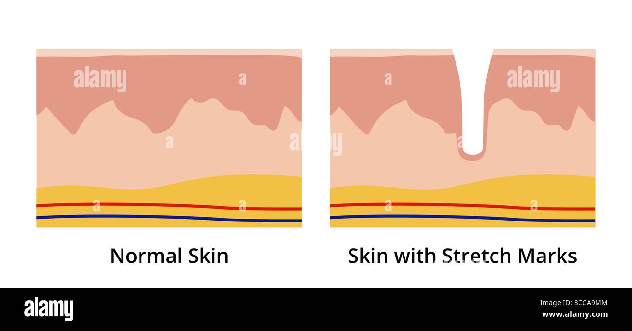 Scar on human skin Stock Vector Images - Alamy
