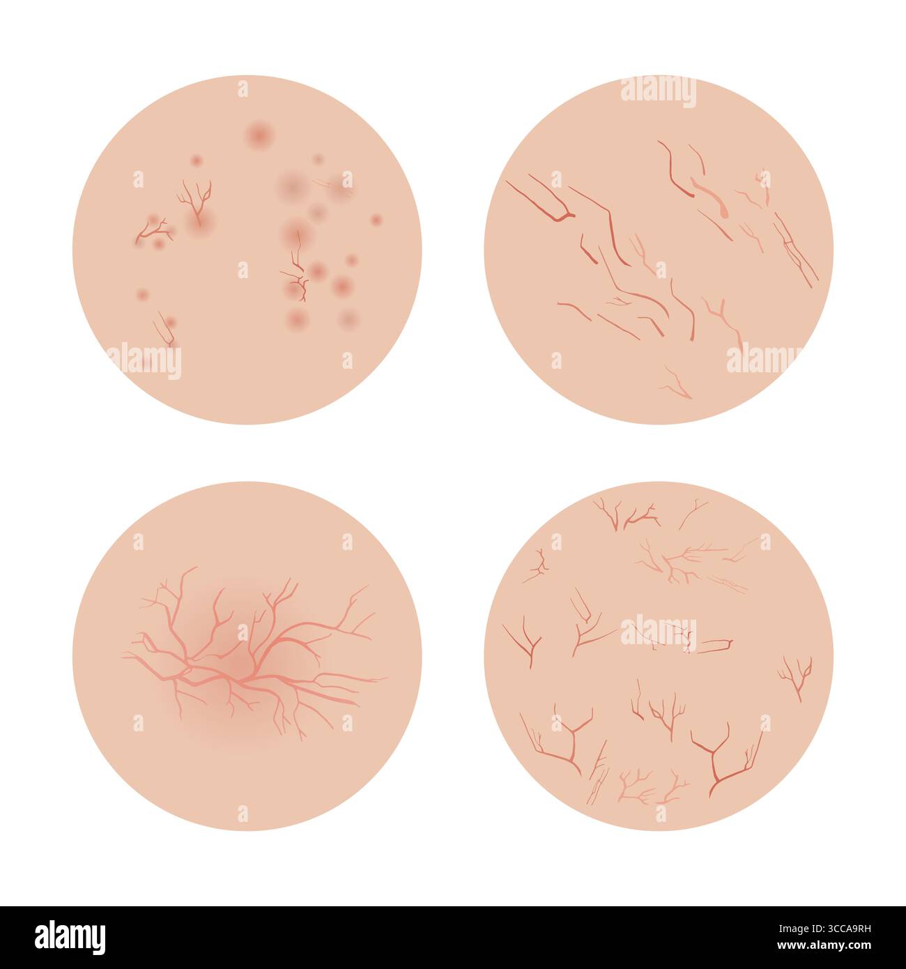 Four Types of Rosacea Showing Different Symptoms on Skin Stock Vector ...