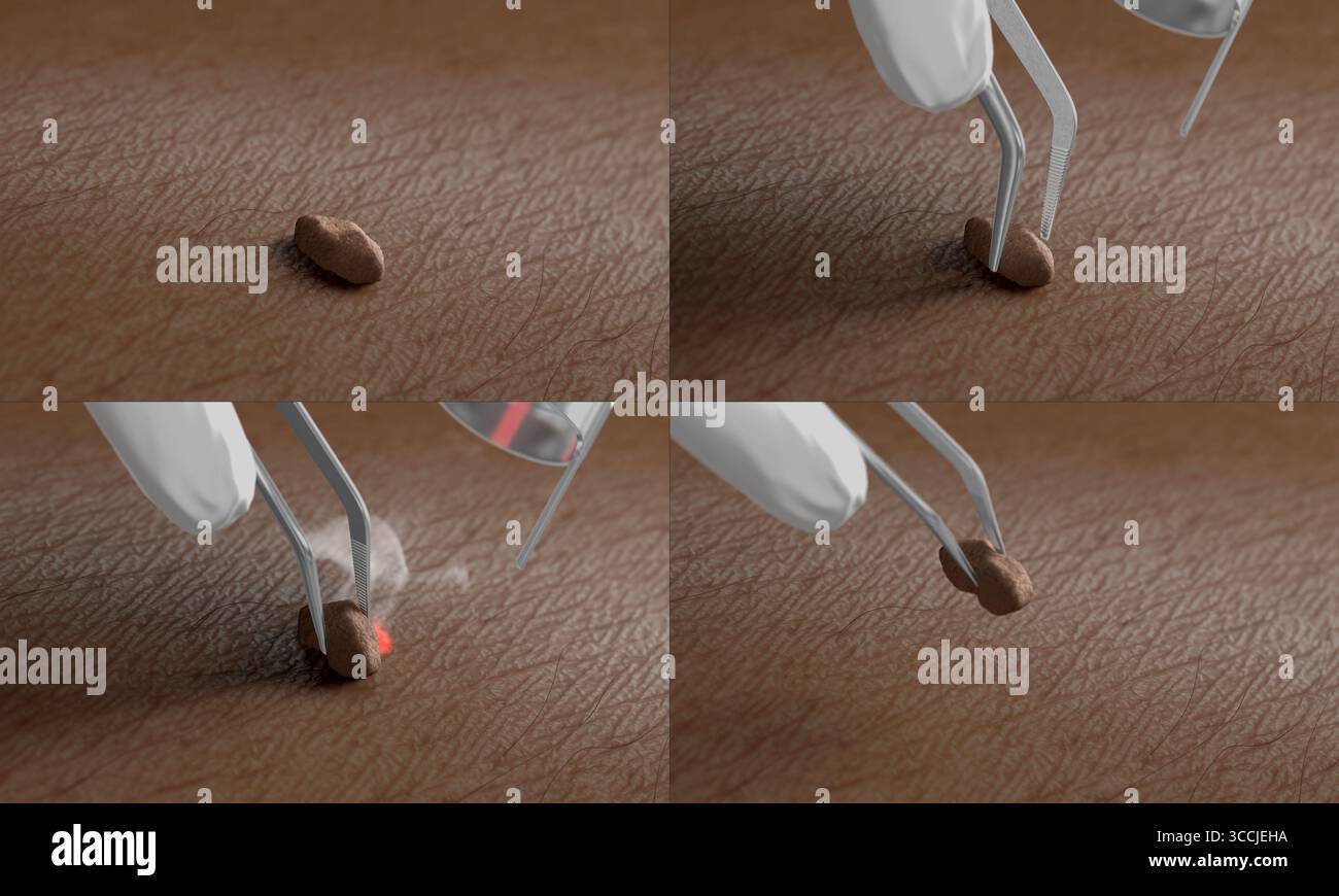 Skin surface with papilloma laser removal treatment process macro Stock ...