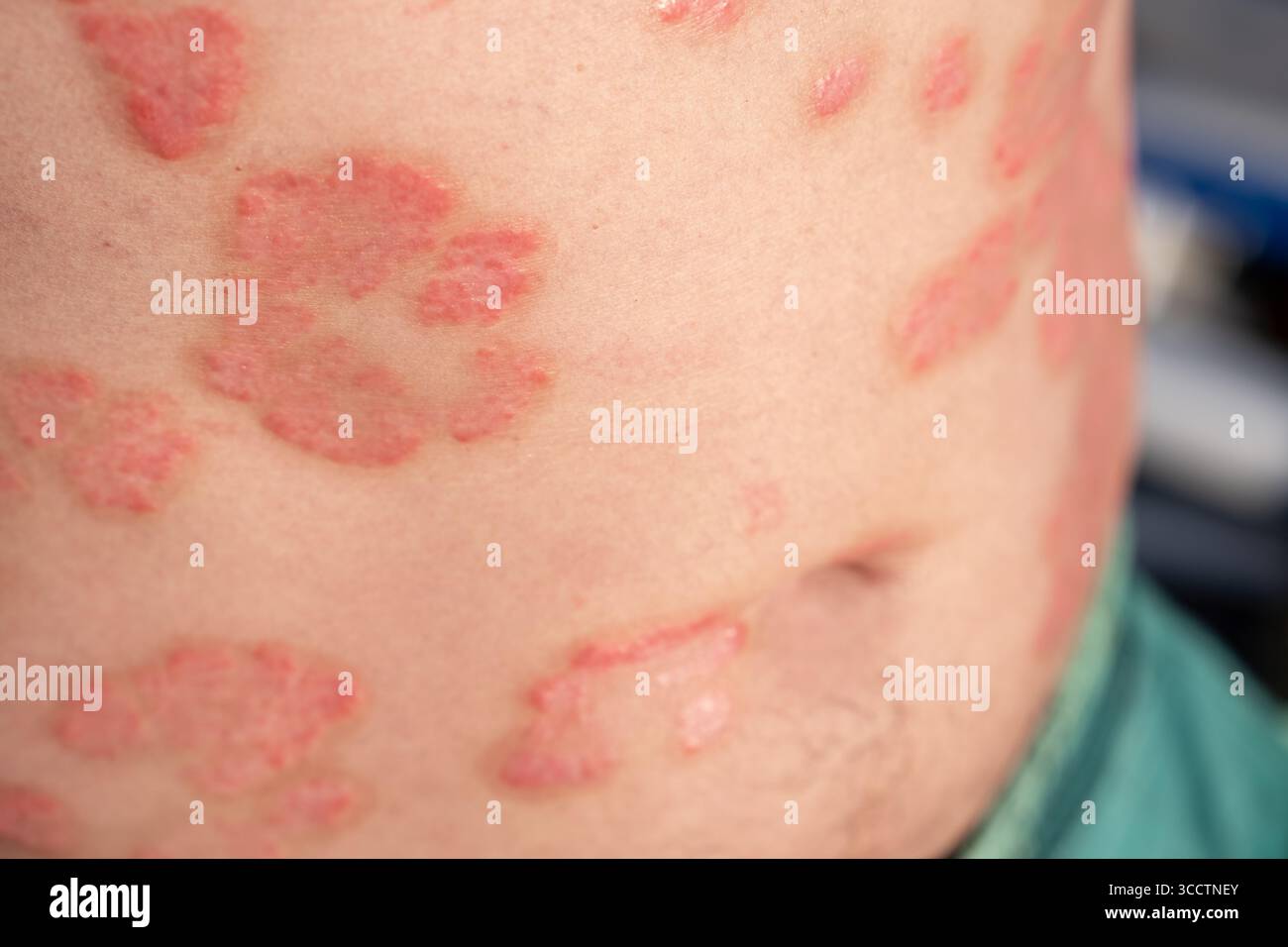 Skin shows red, inflamed patches indicative of psoriasis, a common ...