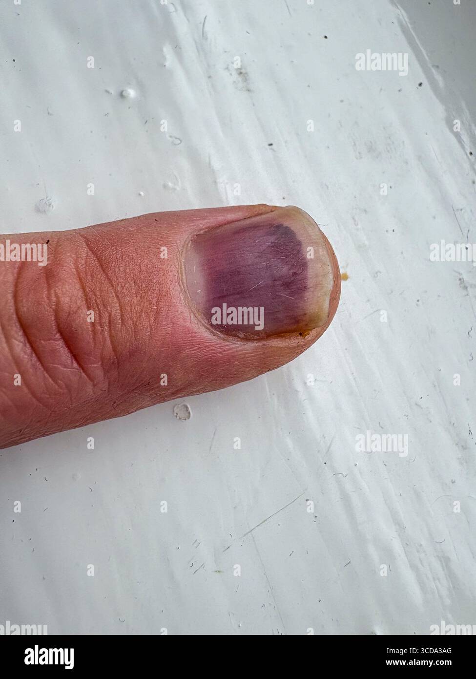 Subungual Hematoma on fingernail. Blood bruise under finger nail due to ...