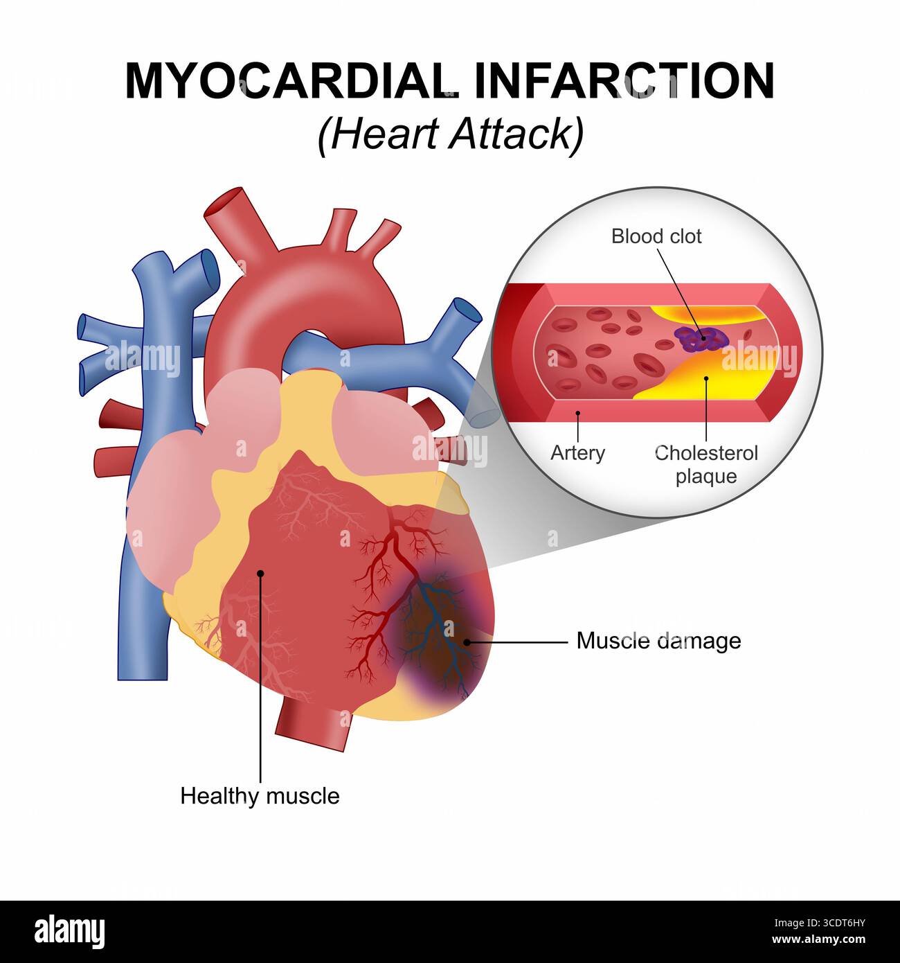 Myocardial Infarction (MI) - Heart Attack Stock Photo - Alamy