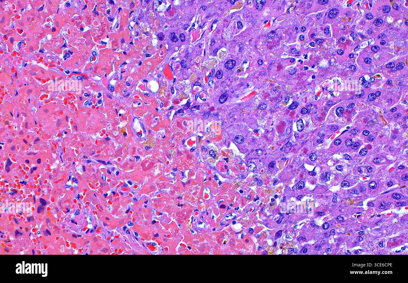 Hepatocellular necrosis hi-res stock photography and images - Alamy