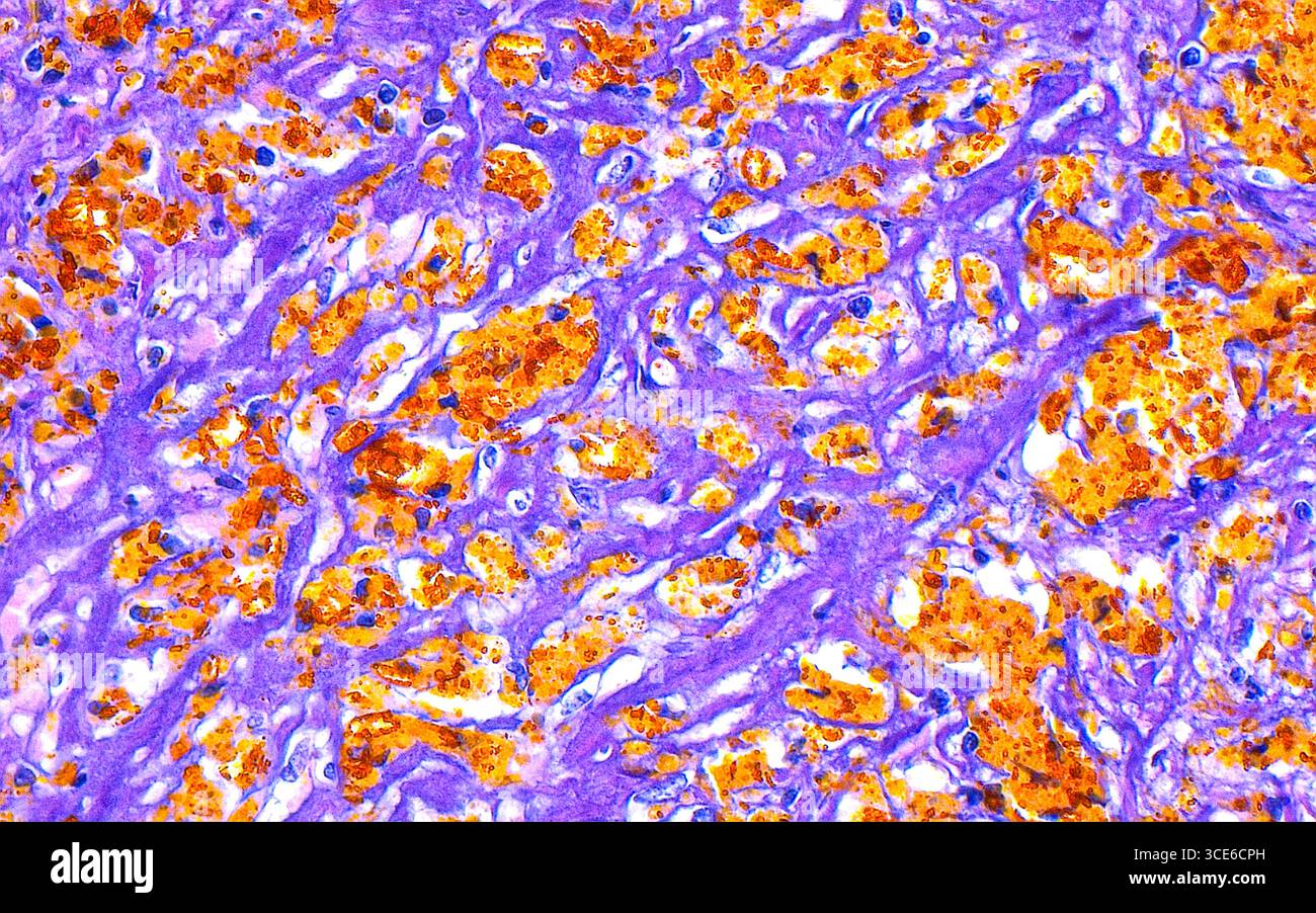 Light micrograph of hematoidin pigment. Hematoidin pigment forms from ...
