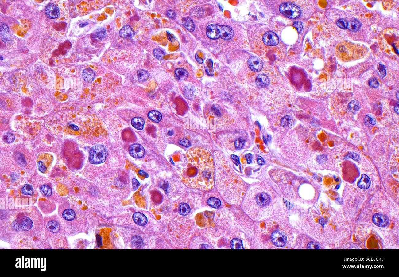 Granular cell tumor hi-res stock photography and images - Alamy