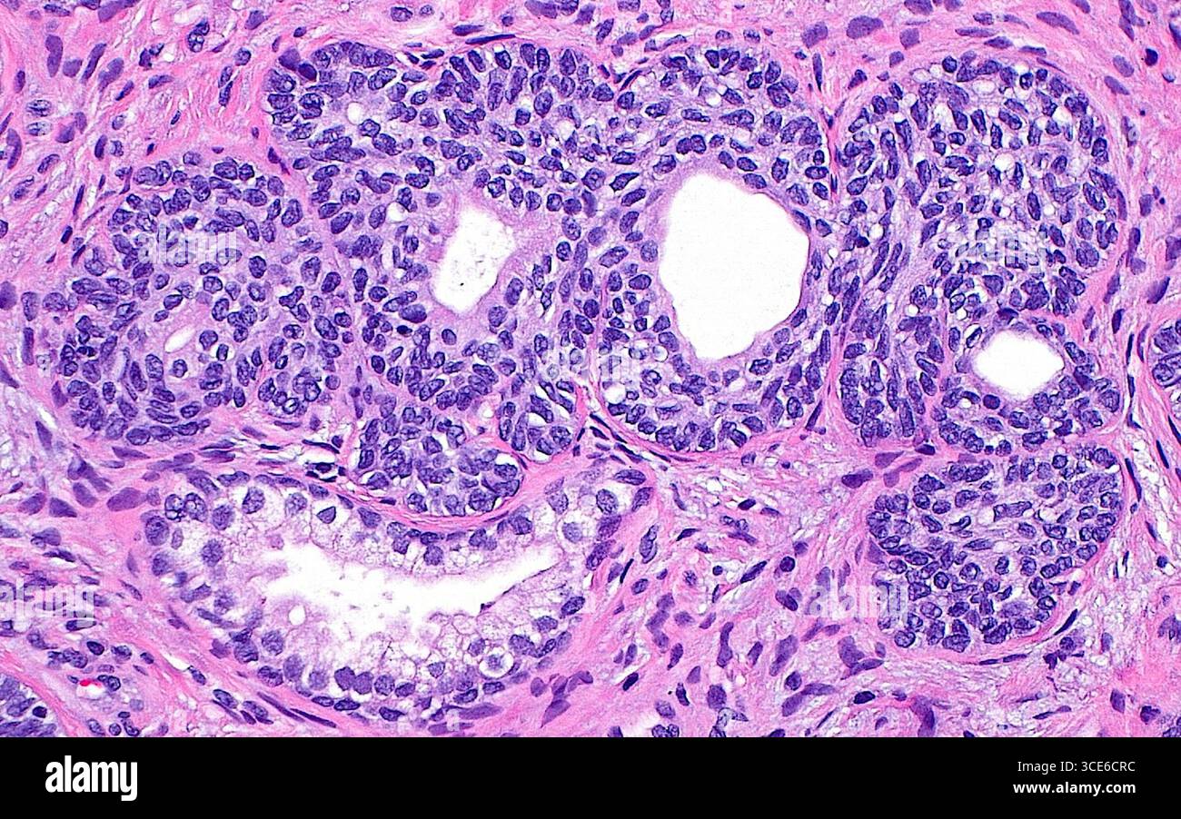 Light micrograph of basal cell hyperplasia in prostate glands. Basal ...