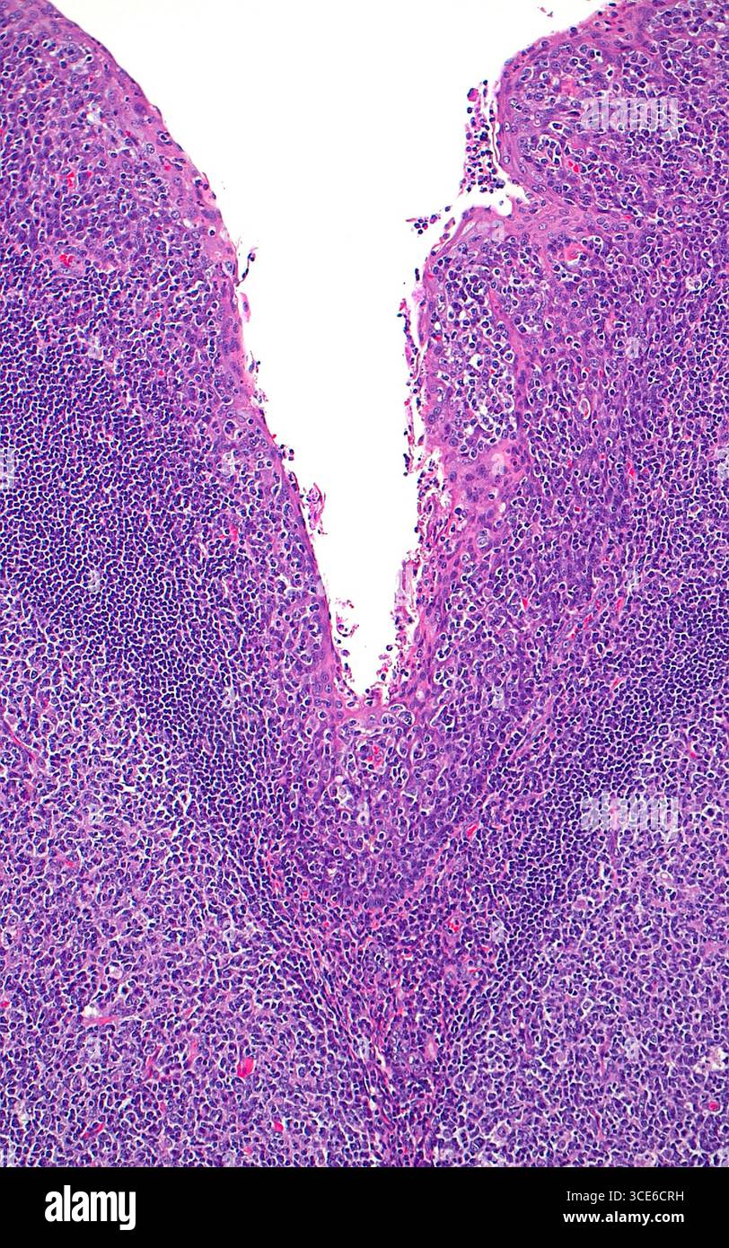 Light micrograph of a tonsillar crypt. Tonsils contain crypts, or ...