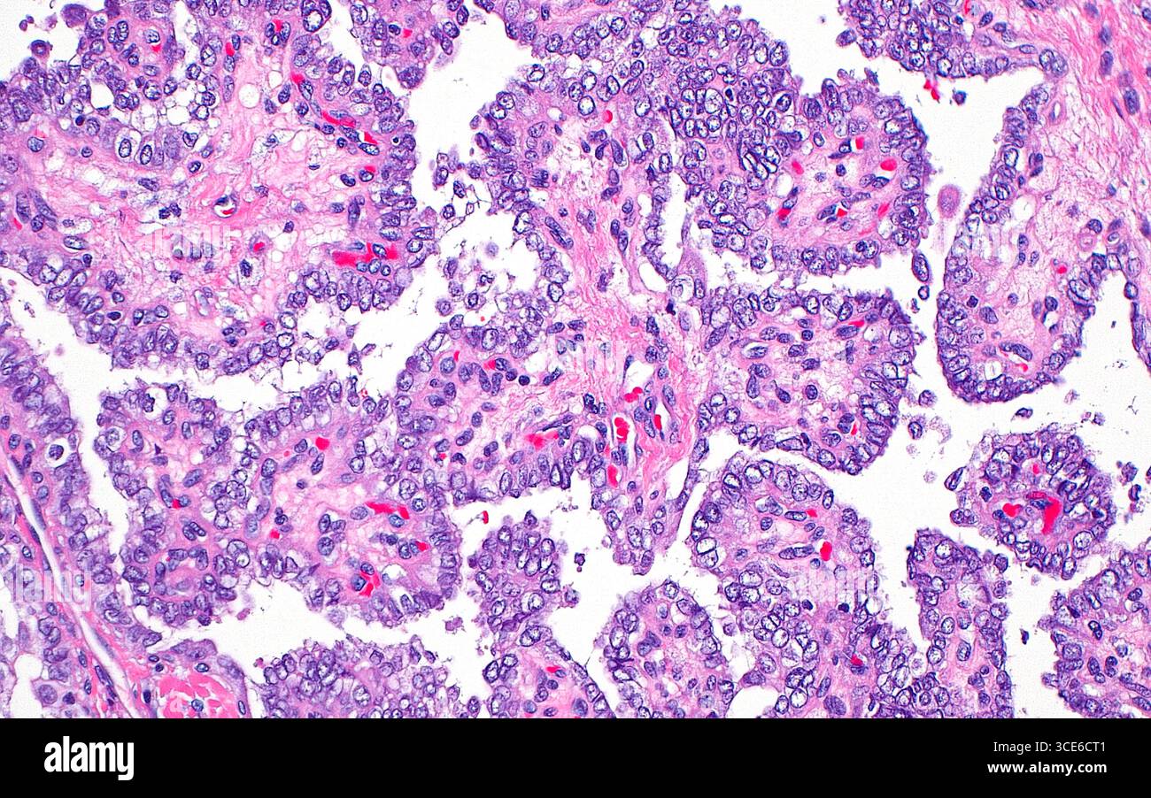 Light micrograph of papillary thyroid carcinoma. Papillary thyroid ...