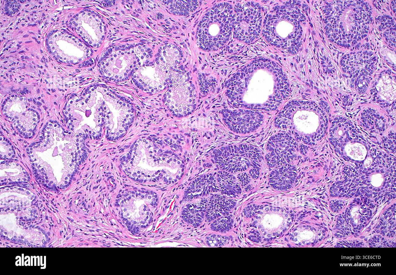 Prostate basal cell hyperplasia hi-res stock photography and images - Alamy