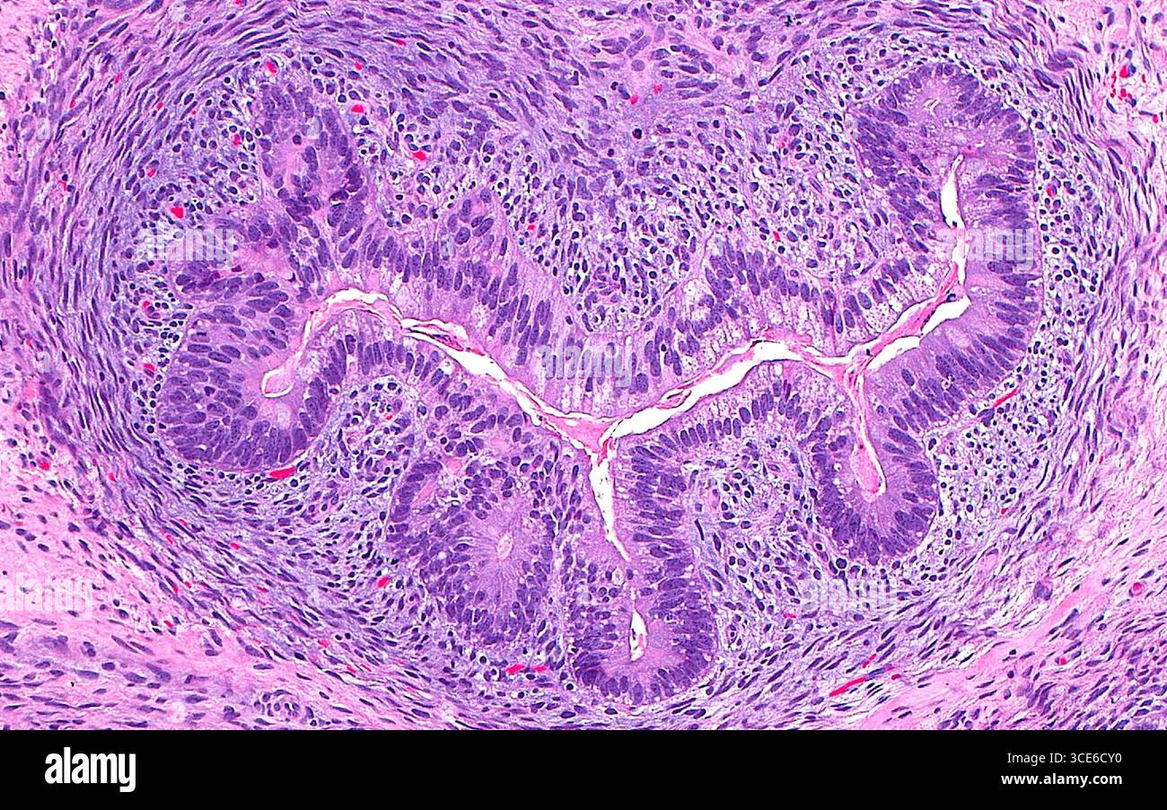 Light micrograph of testicular teratoma. Teratomas are tumours derived ...