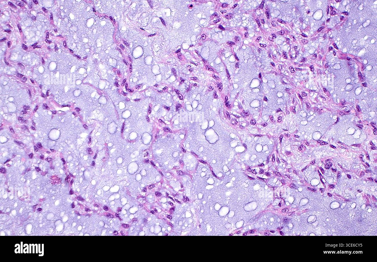 Soft tissue sarcoma hi-res stock photography and images - Alamy