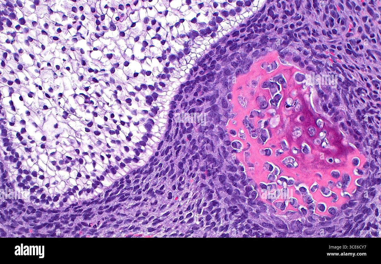 Teratoma hi-res stock photography and images - Alamy