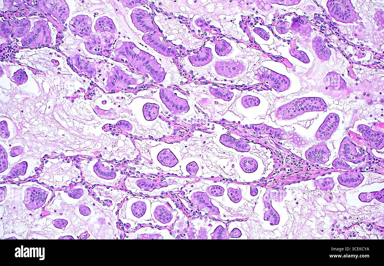 Mucinous lung cancer hi-res stock photography and images - Alamy