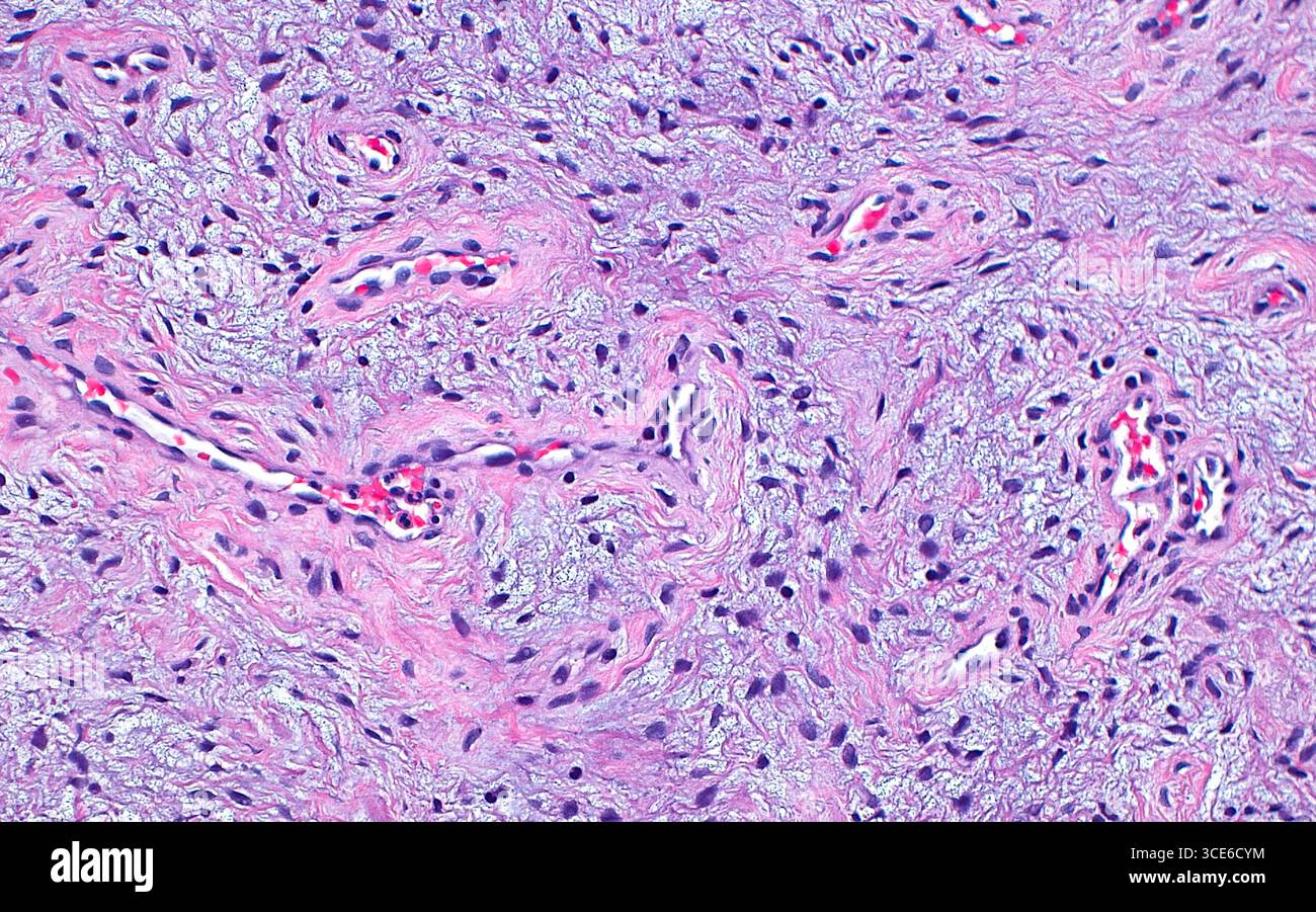 Benign prostate stromal hyperplasia, light micrograph Stock Photo - Alamy