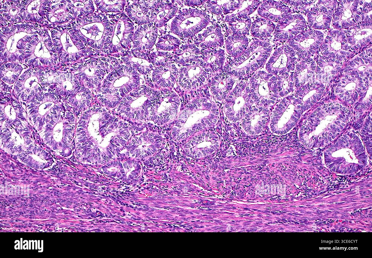 Endometrioid uterine cancer hi-res stock photography and images - Alamy