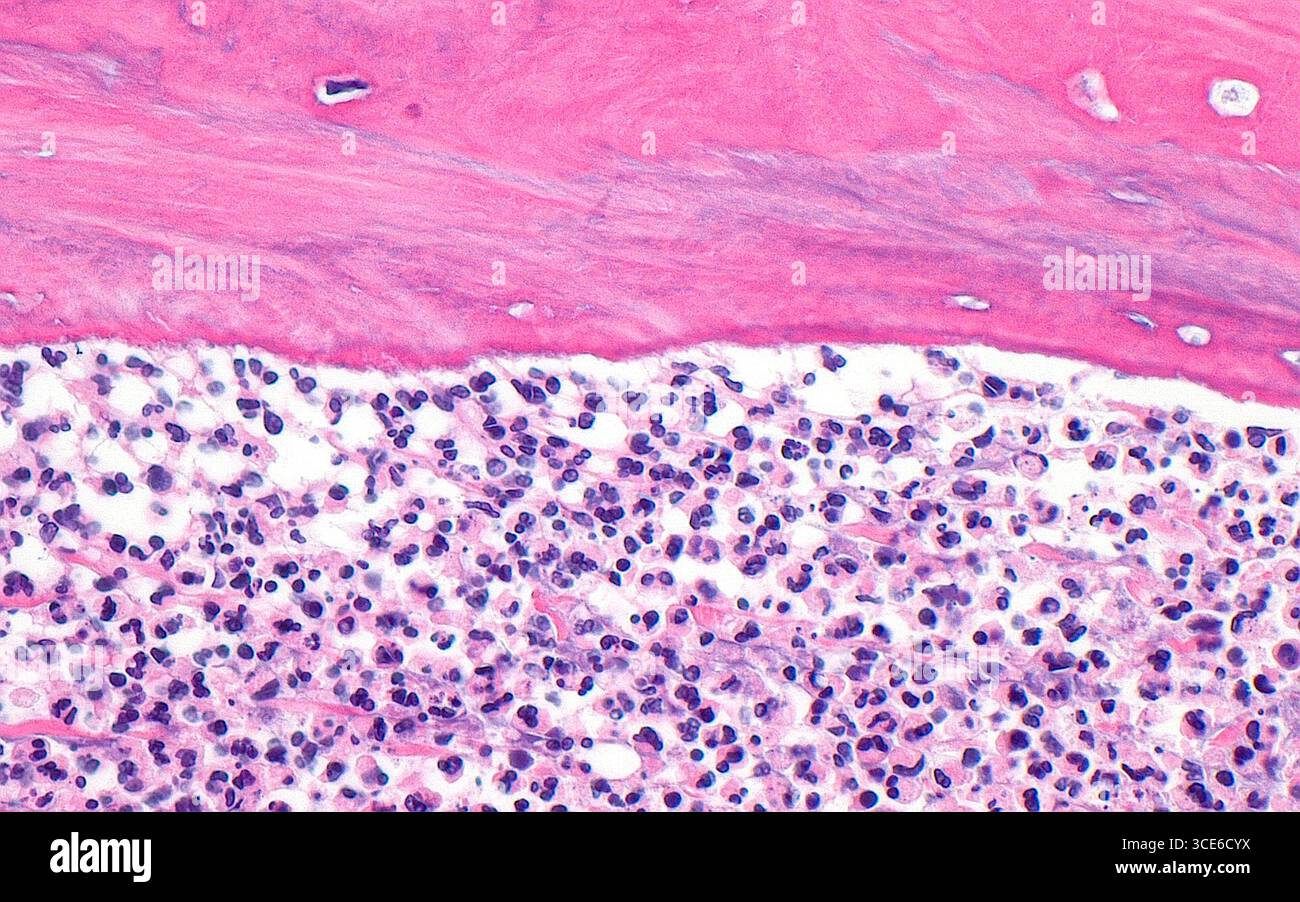 Acute osteomyelitis hi-res stock photography and images - Alamy