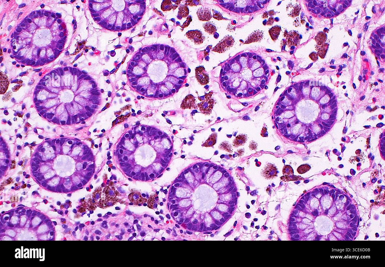 Light micrograph of melanosis coli. Melanosis coli is a type of ...