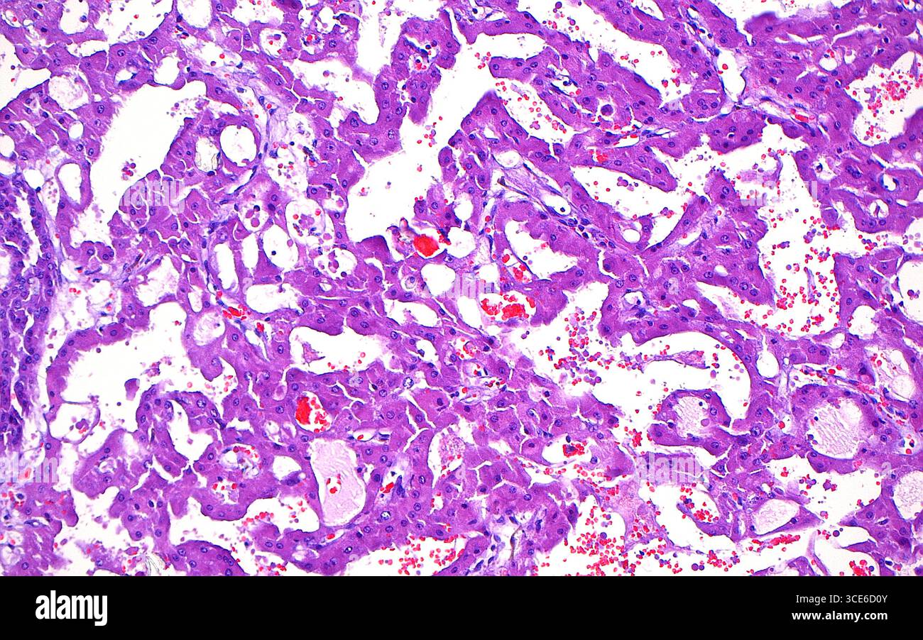 Light micrograph of acquired cystic kidney disease associated renal ...