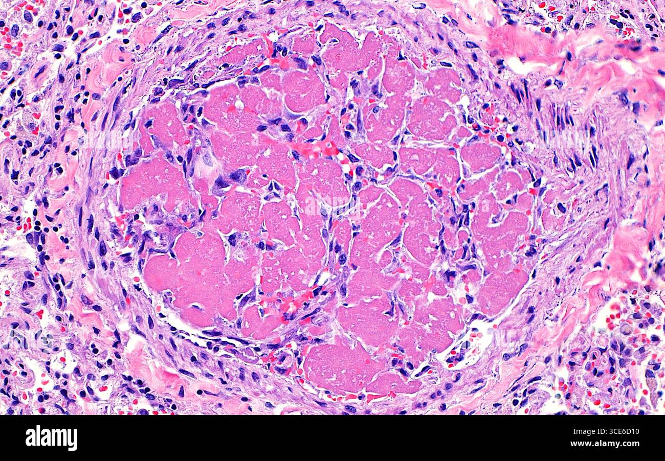 Light micrograph of an organising thrombus within a blood vessel (large ...