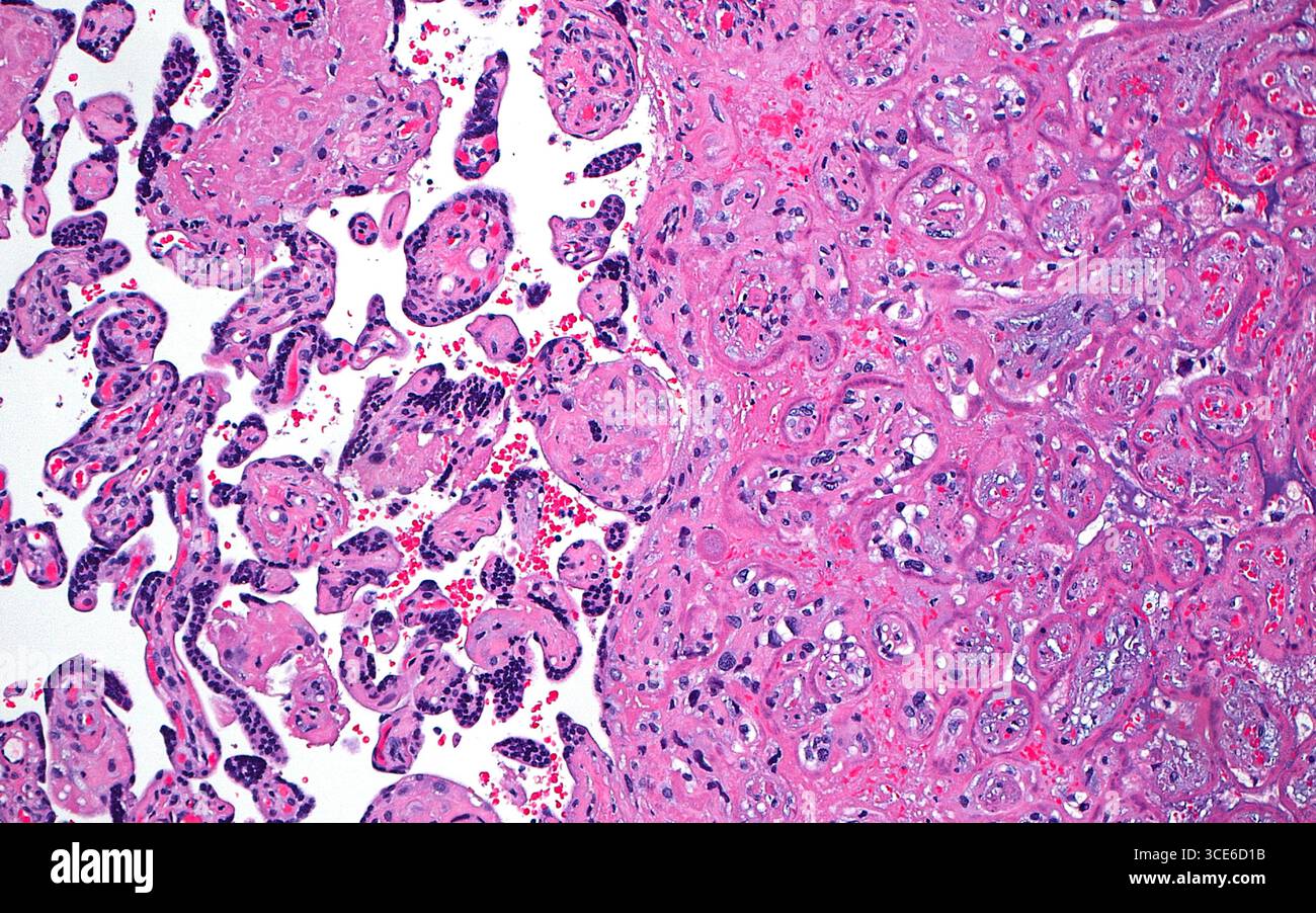 Light micrograph of infarcted placental villi. Infarction of placental ...