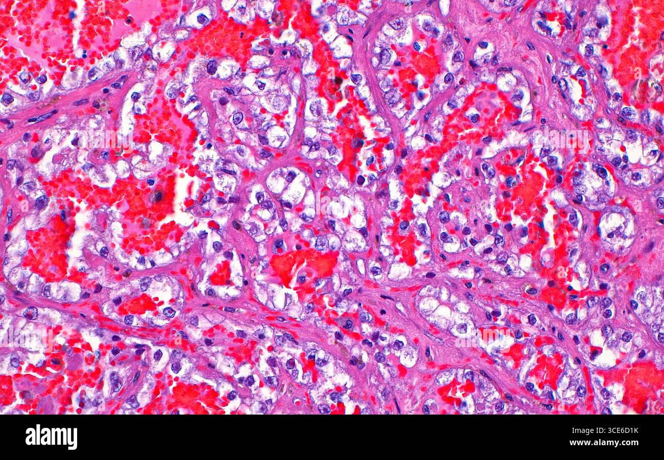 Acquired cystic kidney disease hi-res stock photography and images - Alamy