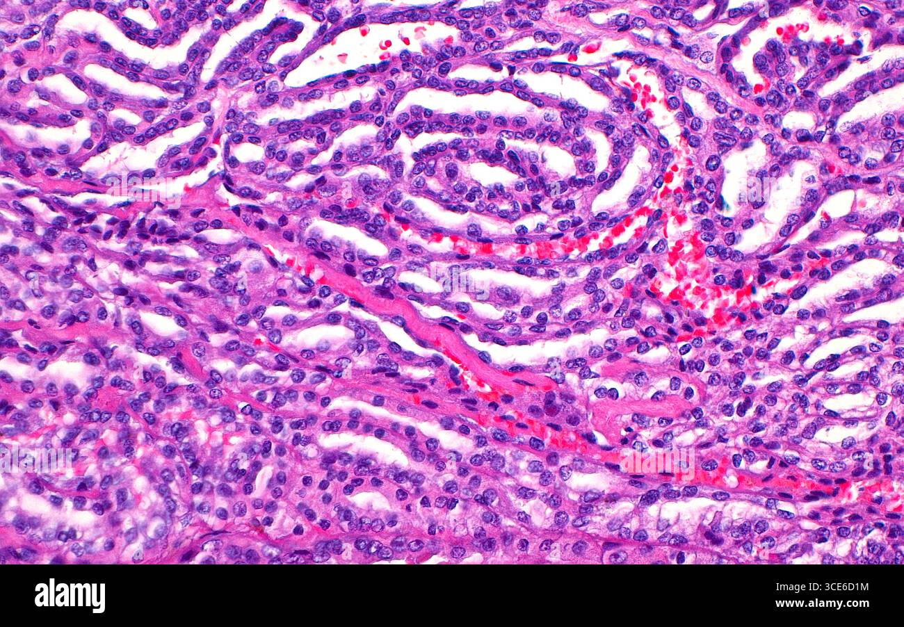Light micrograph of acquired cystic kidney disease associated renal ...