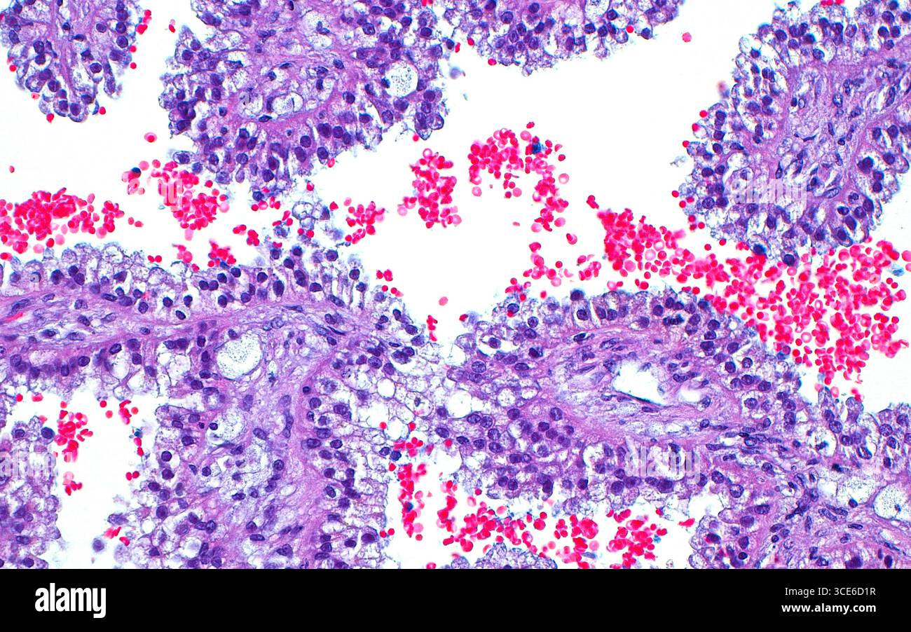 Light micrograph of acquired cystic kidney disease associated renal ...