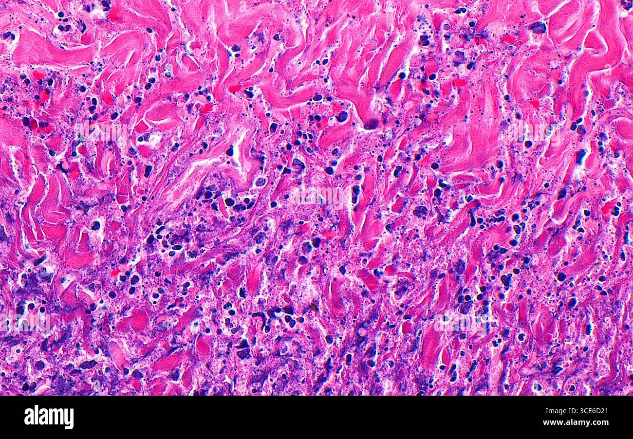Light micrograph of gangrene in fibrous tissue. Gangrene is a type of ...