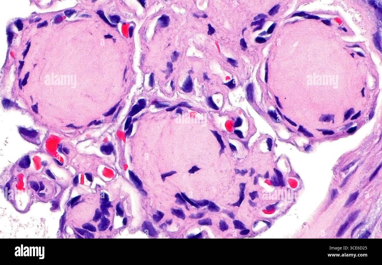 Kimmelsteil wilson nodule hi-res stock photography and images - Alamy