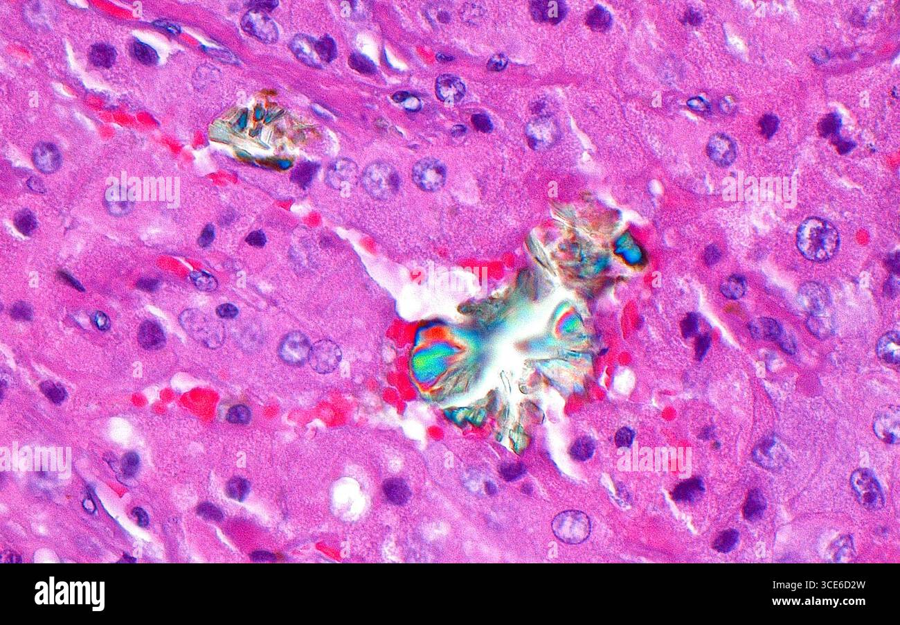 Light micrograph of acquired cystic kidney disease associated renal ...